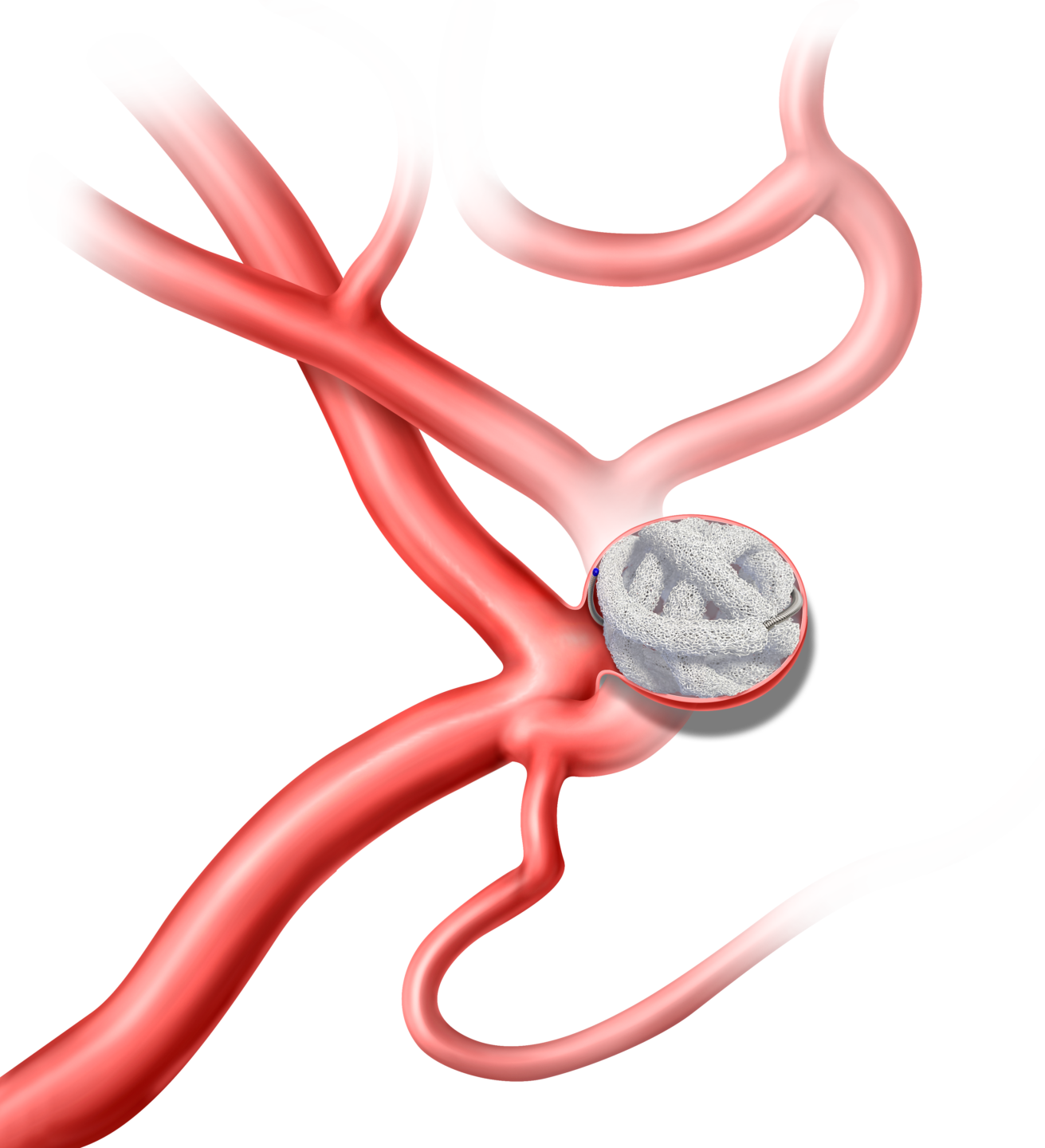 Neurovascular Solutions - Shape Memory Medical - RoW