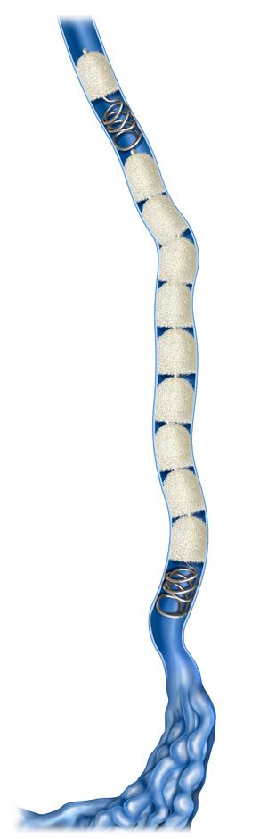 Impede-FX RAPIDFILL - Shape Memory Medical