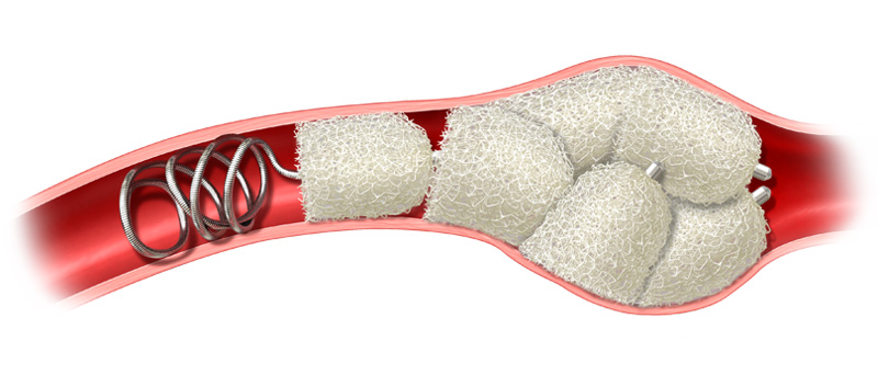 Impede-FX RAPIDFILL - Shape Memory Medical