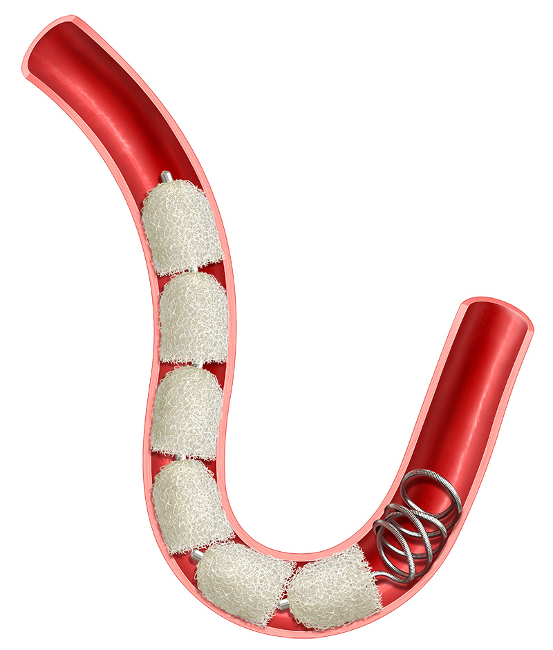 Impede-FX RAPIDFILL - Shape Memory Medical