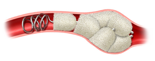 Peripheral Solutions - Shape Memory Medical