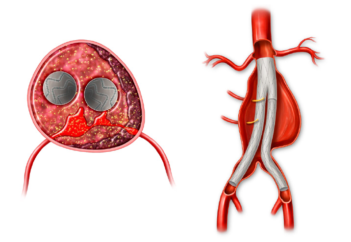 Aortic Solutions - Shape Memory Medical