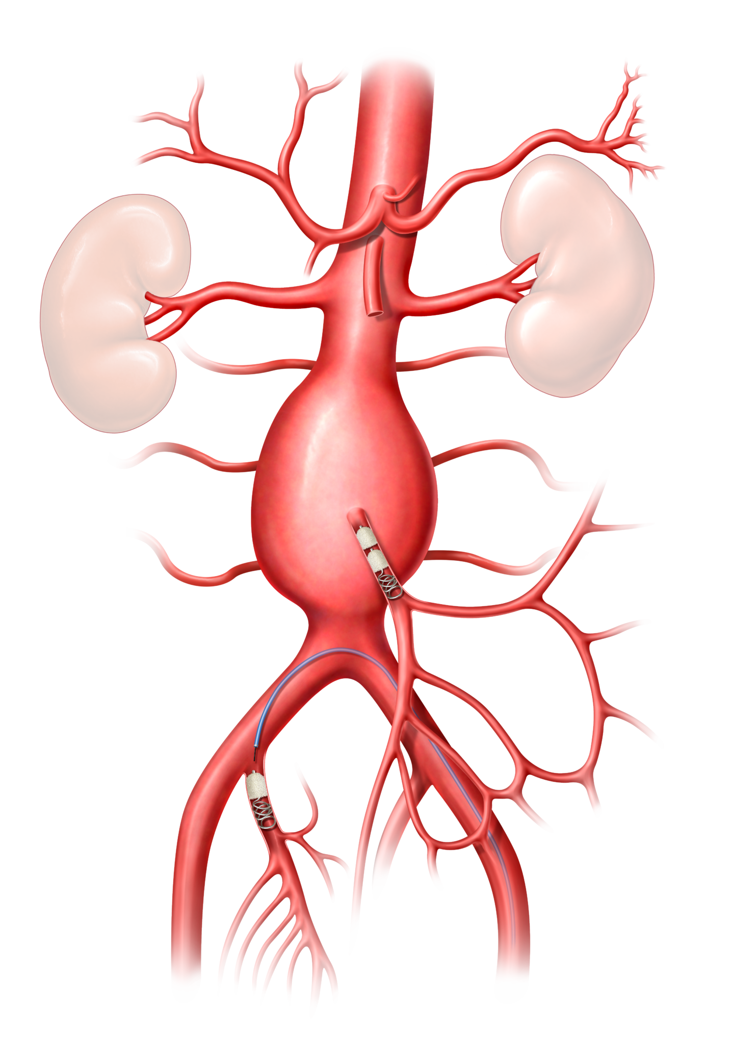 Aortic Solutions- Duplicate page in case MK messes up - Shape Memory ...