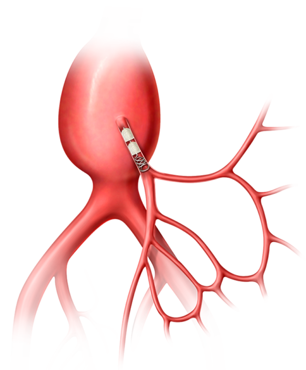 Peripheral Solutions - Shape Memory Medical