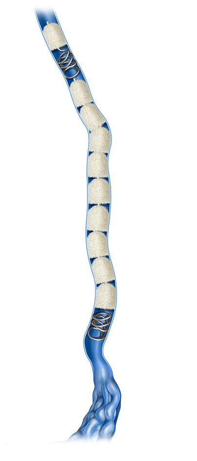 Peripheral Solutions - Shape Memory Medical